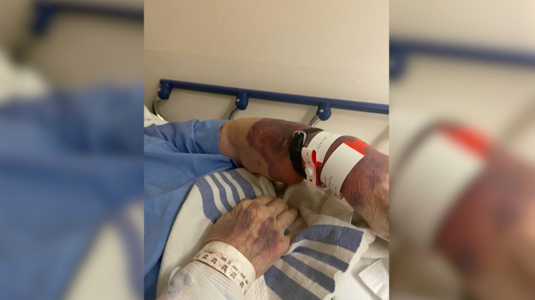 [惊呆]难以置信！加拿大84岁老太急诊室惨遭保安锁头，面部及双臂严重淤青，家人报警！|多伦多|加拿大|社会负面|报警|老人|回应|发现|医院 ...