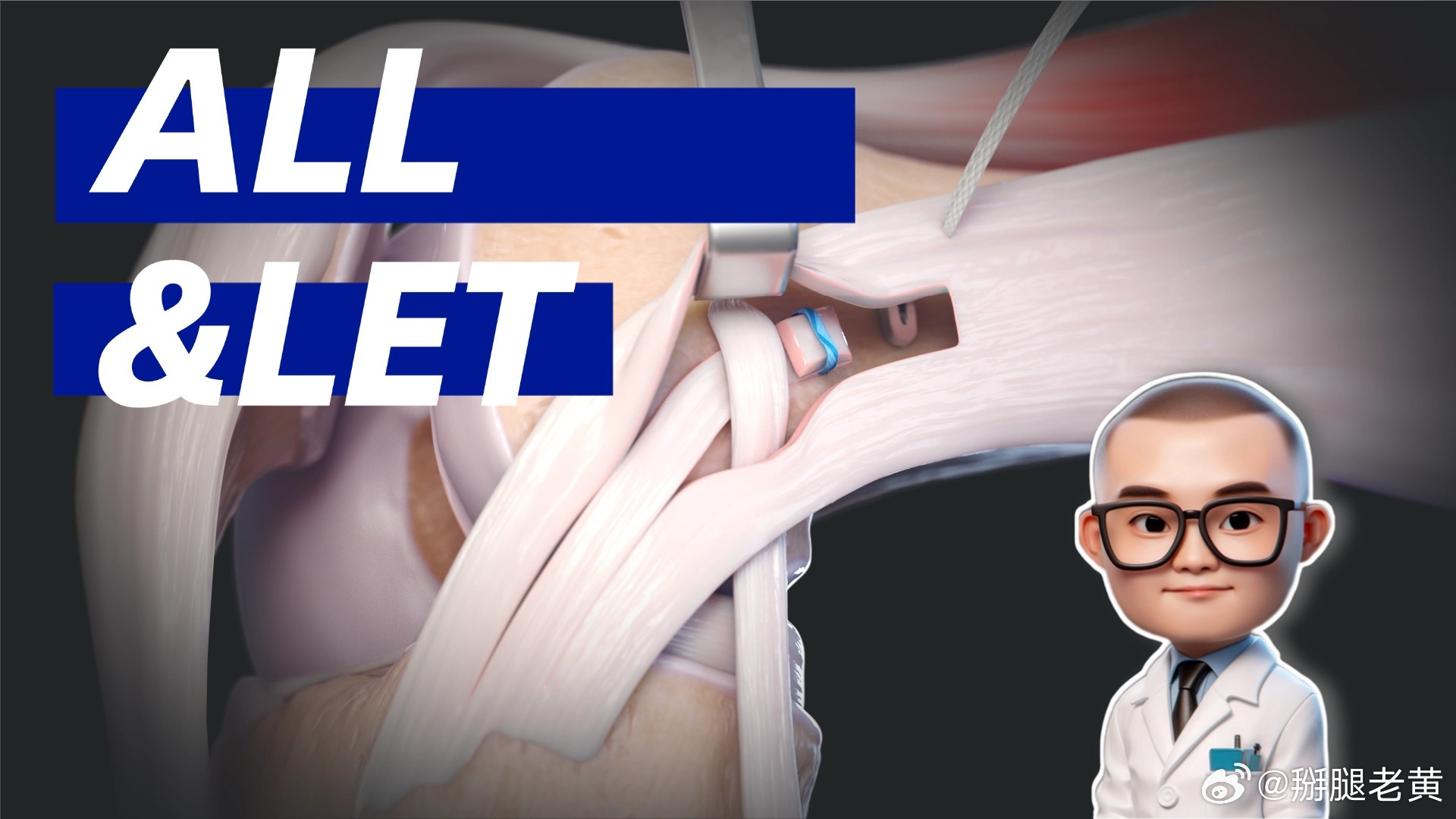 LET技术：ACL重建新趋势|韧带|膝关节|负重|关节松弛|康复_新浪新闻