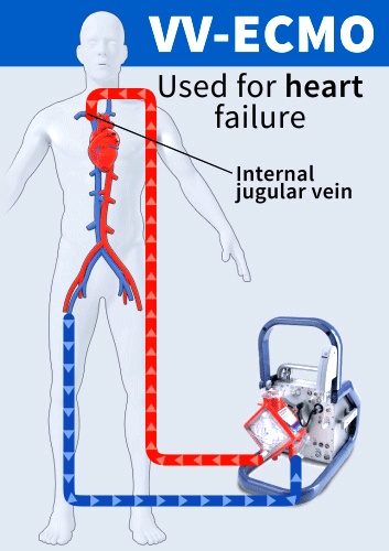 解码——体外膜氧合（ECMO）|肺部|疾病|新冠肺炎_新浪新闻