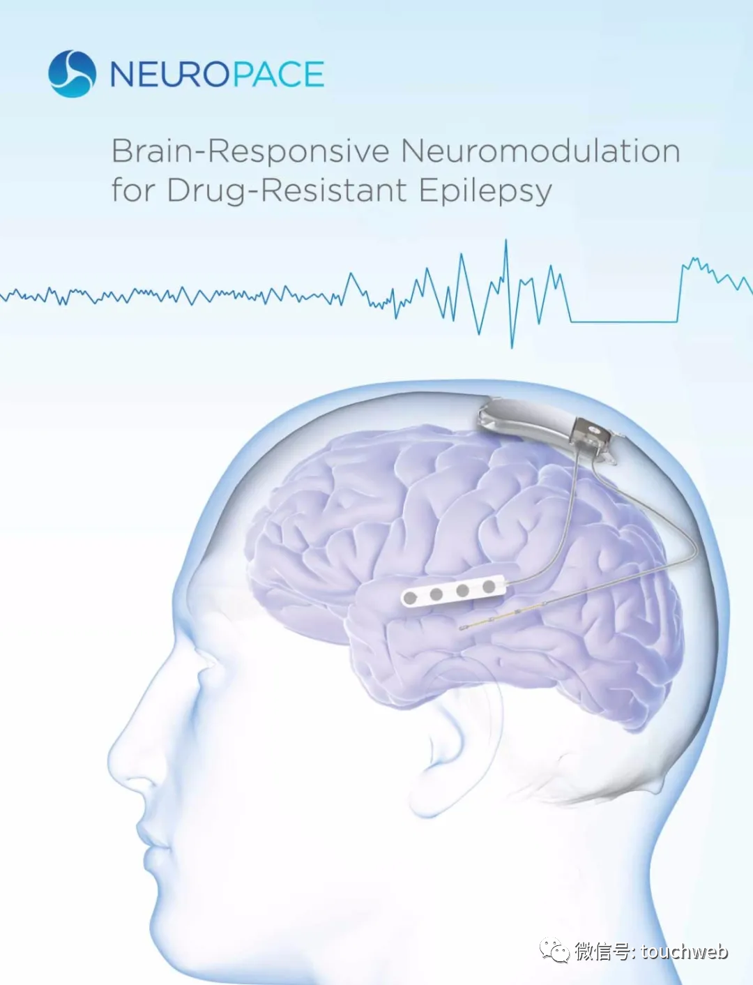 脑神经治疗企业NeuroPace上市：上涨47% 市值5.6亿美元_创事记_新浪科技_新浪网
