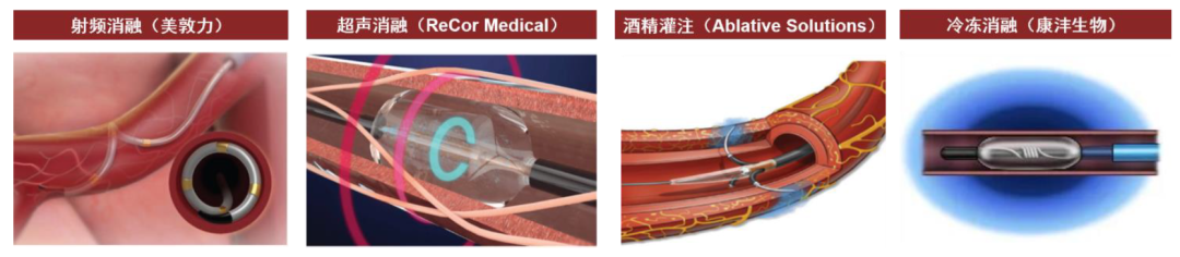 中金 | 肾神经阻断疗法：临床研究峰回路转，介入治疗高血压前景可期_手机新浪网