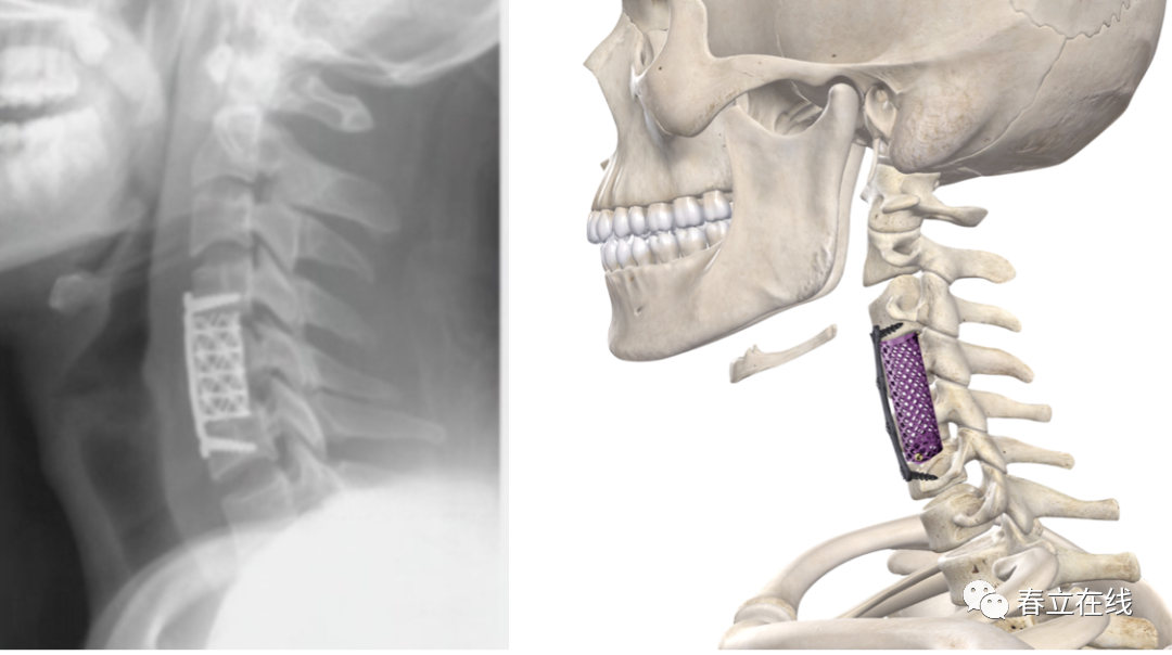 颈椎前路减压融合术|颈椎_新浪财经_新浪网