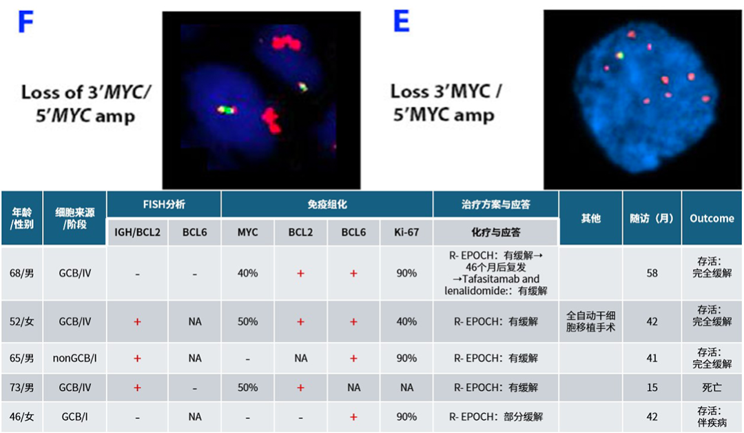 Atypical pattern in FISH ｜我们正致力于解读不典型信号（淋巴瘤篇-1）|文献_新浪财经_新浪网