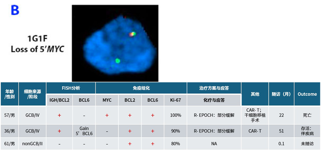 Atypical pattern in FISH ｜我们正致力于解读不典型信号（淋巴瘤篇-1）|文献_新浪财经_新浪网