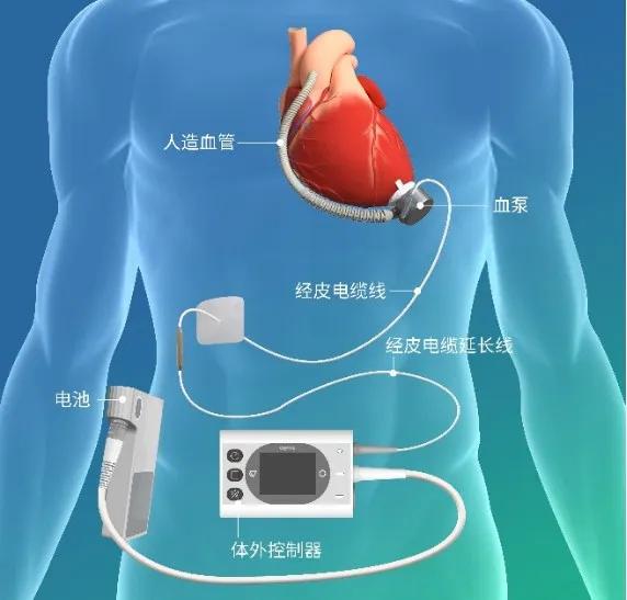 人工心脏纳入医保，全国四家医院开启试点！_新浪财经_新浪网