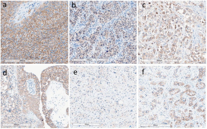 Nectin-4 IHC+FISH | 双管齐下，靶向更准|肿瘤_新浪财经_新浪网