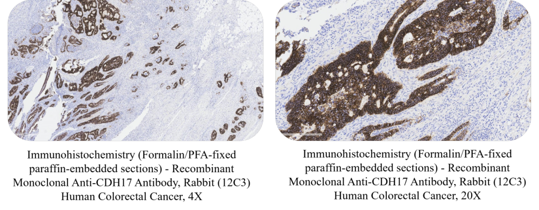 CDH17靶向药物崛起：IHC验证驱动消化道癌治疗突破|肿瘤_新浪财经_新浪网