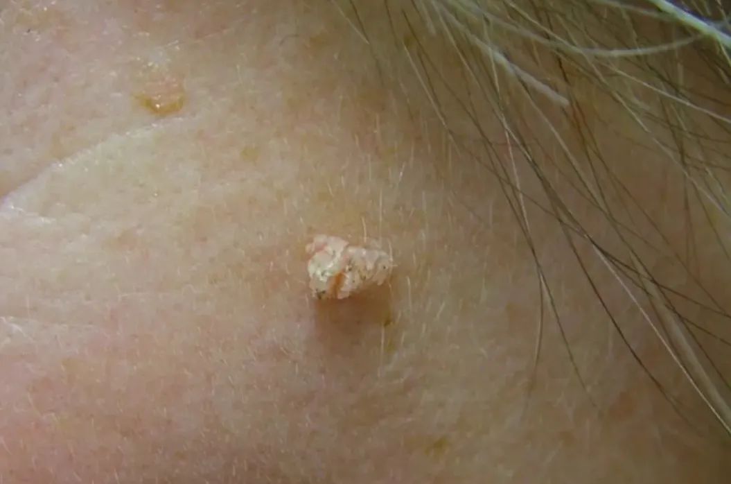 脖子上长出的小肉粒，到底是啥啊？|HPV_新浪财经_新浪网