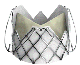 健适医疗“J-VALVE TF经导管主动脉瓣膜系统”获批|手术_新浪财经_新浪网